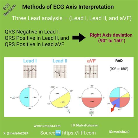 Ecg Axis Interpretation Three Lead Medical Education Facebook