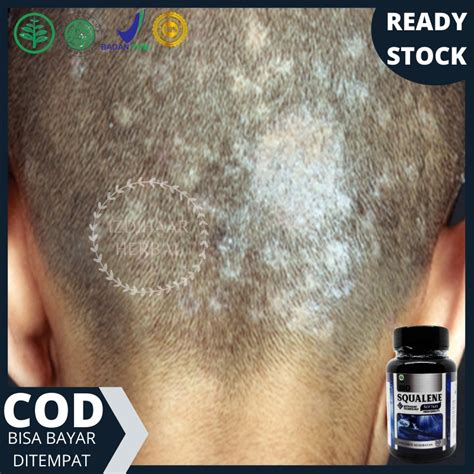 Jual Obat Herbal Tinea Capitis Kapitis Obat Tinea Capitis Kapitis Obat Jamur Kulit Kepala