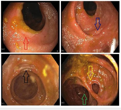 Ascending Colon Colonoscopy
