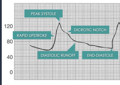 Aacn Ecco 4 0 Hemodynamic Monitoring Critically Ill Patients Part 1 Icu Arterial Catheter