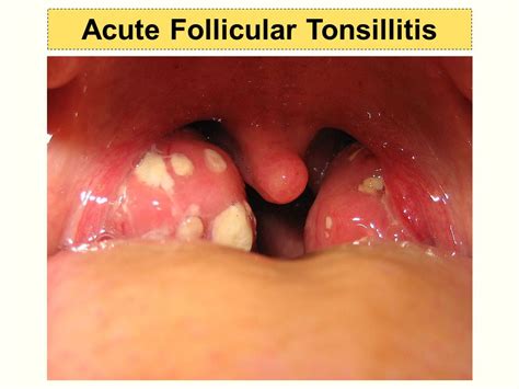 Diseases Of The Respiratory System Ppt Video Online Download
