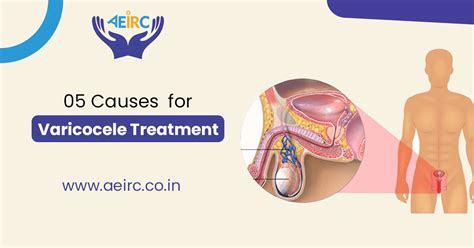05 Causes For Varicocele Treatment Aeirc Clinic