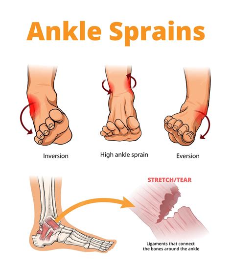 Premium Vector Illustration Of Ankle Sprains Types