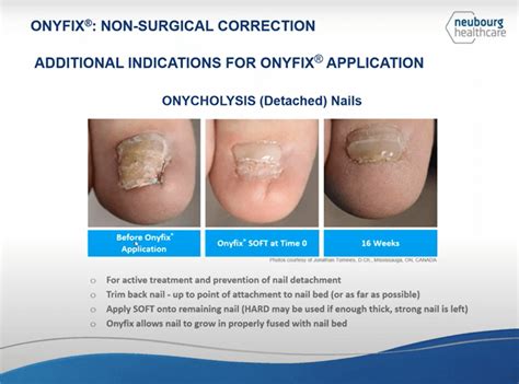 Onyfix Ingrown Toenail Treatment Podiatrist Foot Doctor Hallandale