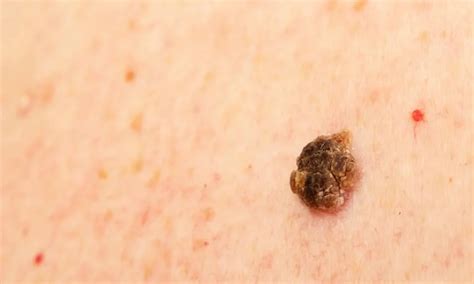 Queratosis Seborreica Qué Es Causas Y Tratamientos Cdi