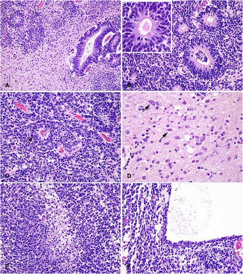 Ependymoma Pseudorosettes