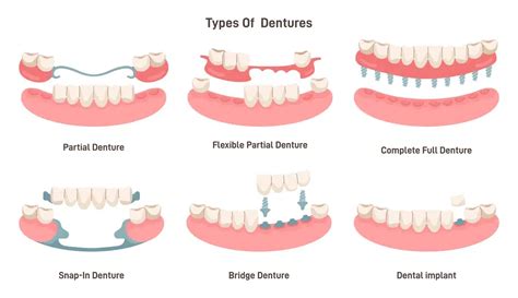 Immediate Dentures Steps