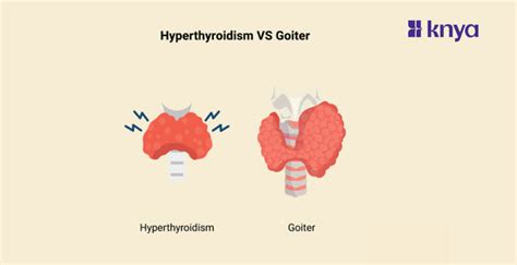 Difference Between Hyperthyroidism And Goiter Explained Knya