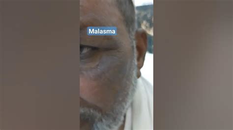 Malasma Anm Herbal Health And Skincare Clinic Youtube