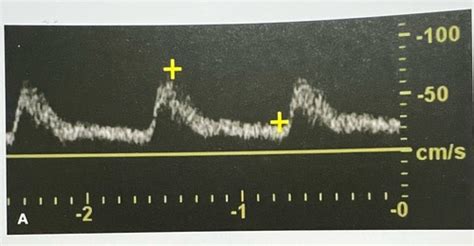 Dms 260 Ch 4 Pw Doppler Waveforms In Peripheral Arteries Flashcards