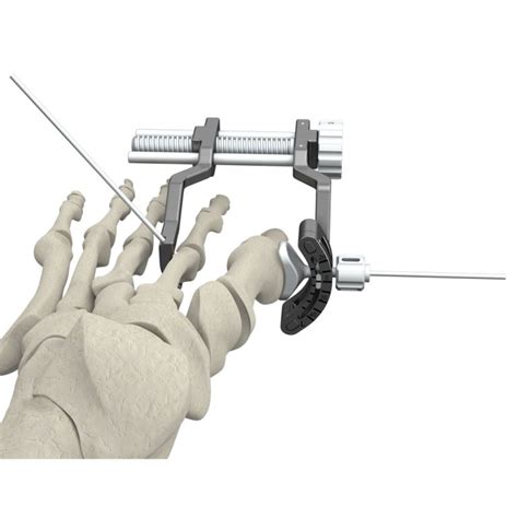 Freedom Lapidus Joint Preparation And Alignment System Extremity Medical