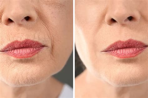 Wrinkles And Fine Lines Lifemd
