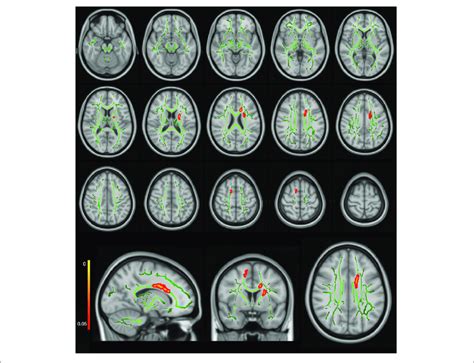 Axial Diffusivity Ad Map Showing Significantly Higher Ad Values In