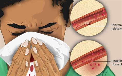 Platelet Disorders My Hematology