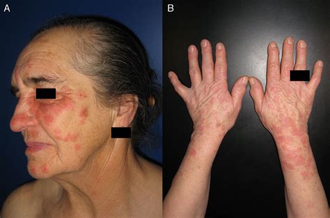 Erythema Migrans Vs Erythema Multiforme