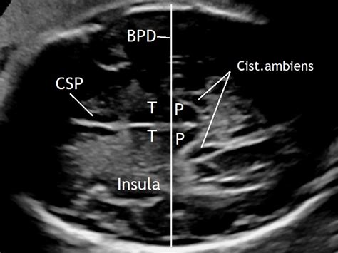 How To Measure The Bpd Gynaecologia