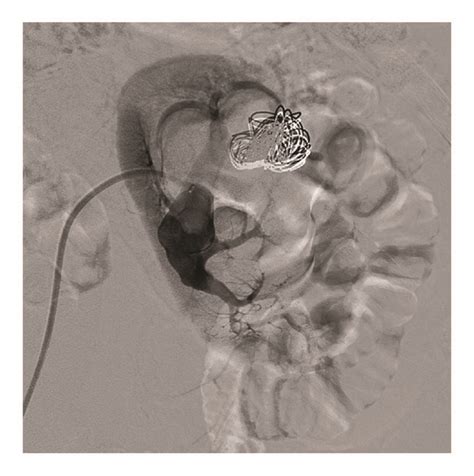 Control Angiogram After Embolization Download Scientific Diagram