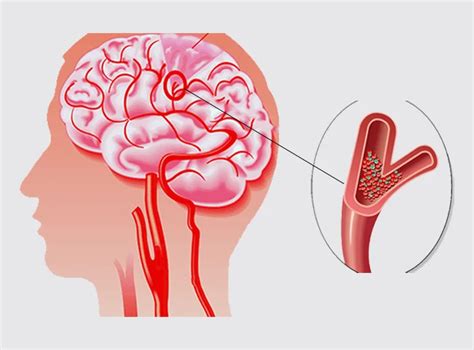 Transient Ischemic Attack Symptoms And Causes