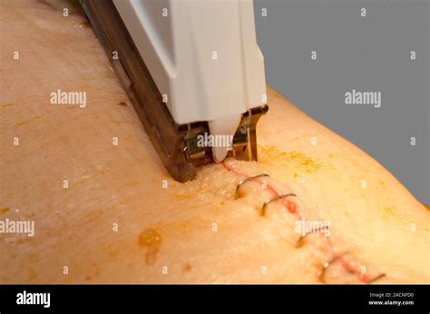 Knee Replacement Surgery Surgeon Stapling The Incision After Total
