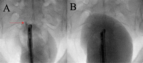 Cystogram A 5fr Open Ended Catheter Arrow Directed Contrast