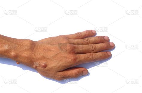 神经纤维瘤病发生在手部