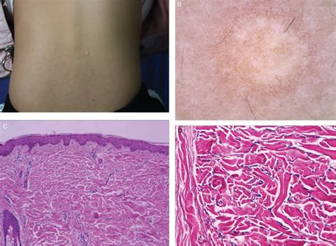 Dermoscopy Of Papular Elastorrhexis Chinese Medical Journal