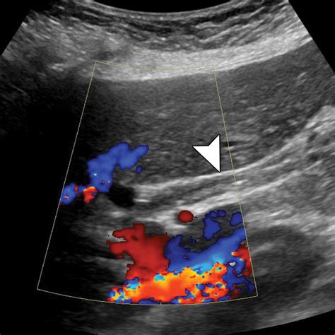 Imaging Features Of Primary Sclerosing Cholangitis From Diagnosis To