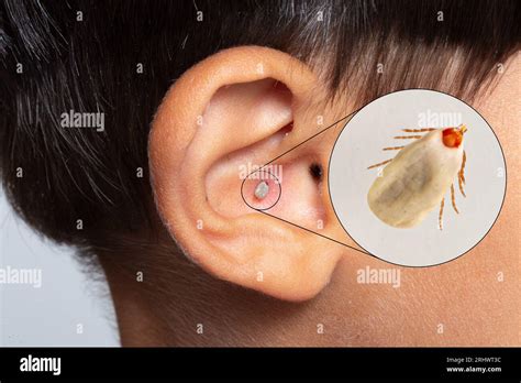 What Causes Ticking In The Ear At Marcus Dacomb Blog
