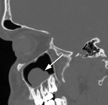 Retention Cyst Of The Maxillary Sinus Image Cbct Paranasal Case