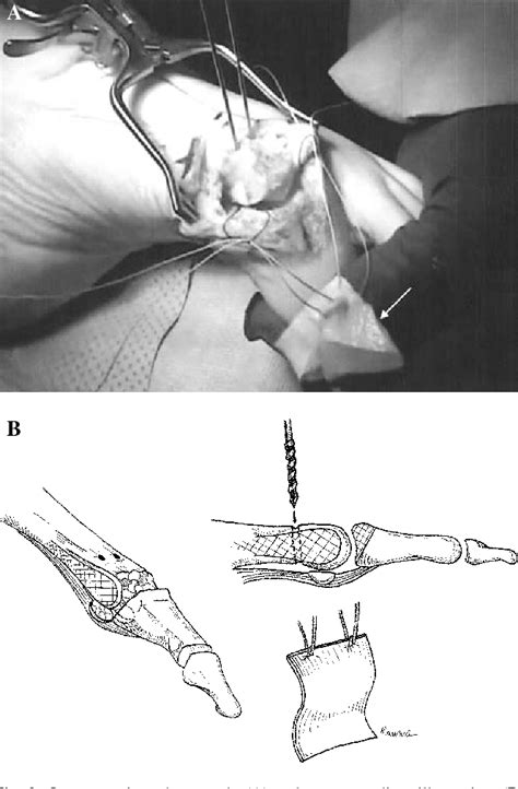 Figure 4 From Interpositional Arthroplasty Of The First Mtp Joint Using A Regenerative Tissue