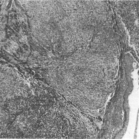 Microscopically It Is Nodular In Configuration And Consists