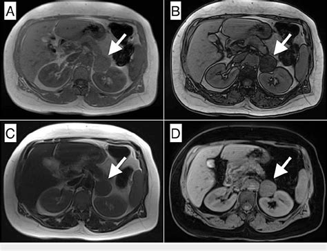 Figure 2 From A Rare Triplet Found In A Patient With Drug Resistant