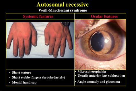 Ppt Ectopia Lentis Powerpoint Presentation Free Download Id6747605