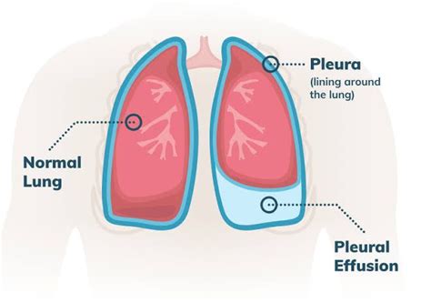The Science Behind Pleural Effusion My School Exams