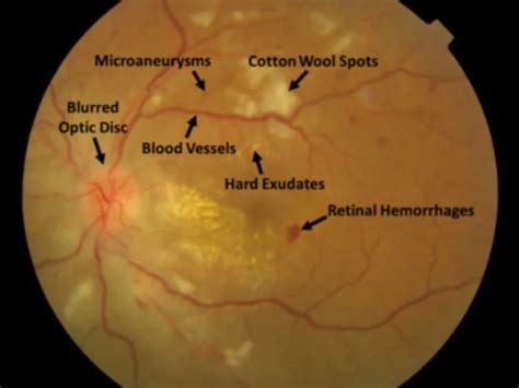 Medical Annotation For Ophthalmology Annotation Box
