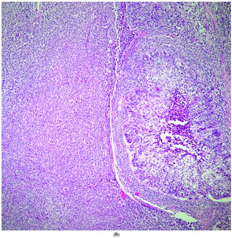 A Sarcomatoid Carcinoma Associated With Areas Of Conventional Download Scientific Diagram