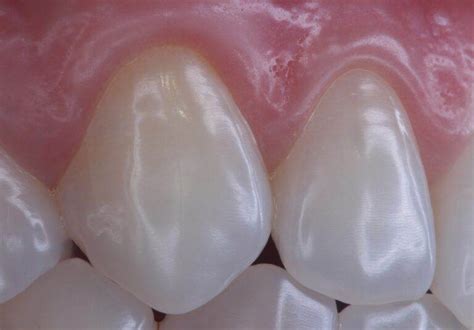 Jaw Out Of Whack Signs You Have A Misaligned Jaw And How To Fix It