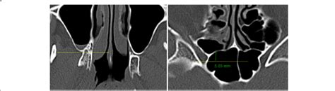 Relative Position Of Posterior Ethmoid Sinus To Posterior Maxillary