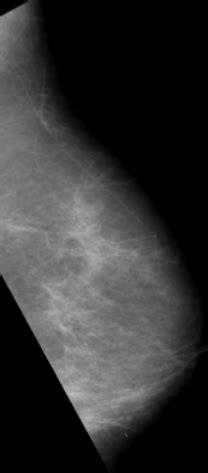 Python Cropping Image Around Mammogram Object Stack Overflow