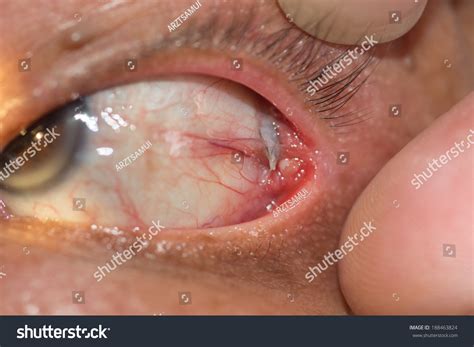Dermoid Cyst Ovary Eye