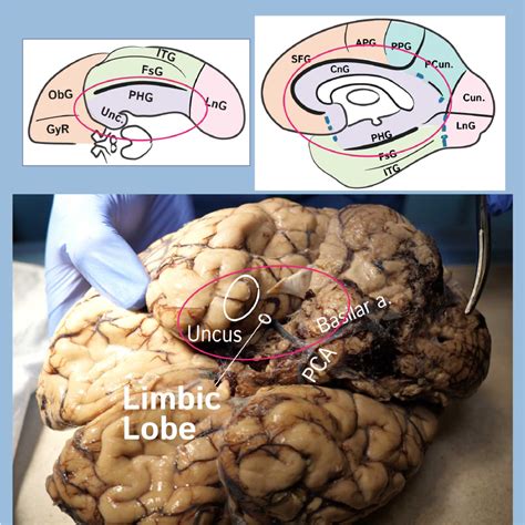 Neuroanatomy Glossary Cerebrum Limbic Lobe Ditki Medical