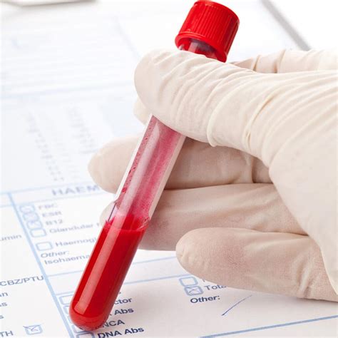 Prealbumin Test Smartly Labs