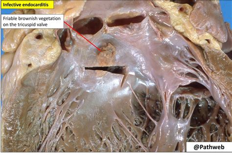 Endocarditis Vegetation