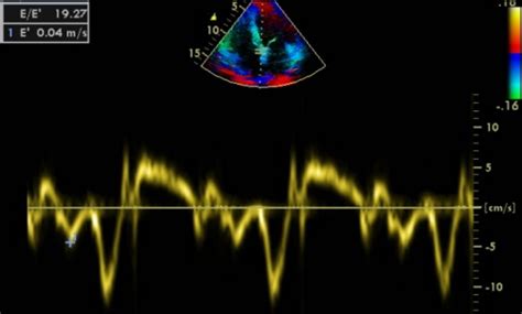 Diastolic Dysfunction By Tissue Doppler All About Cardiovascular