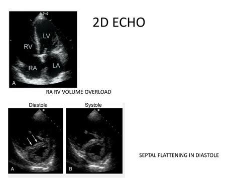 Ppt Echo Assessment Of Atrial Septal Defect Powerpoint Presentation