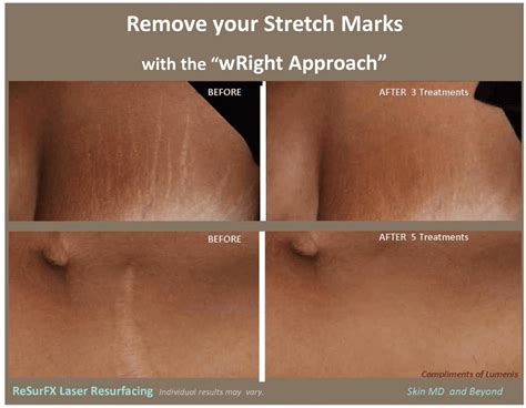 Stretch Marks Treatment