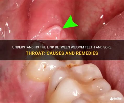 Understanding The Link Between Wisdom Teeth And Sore Throat Causes And