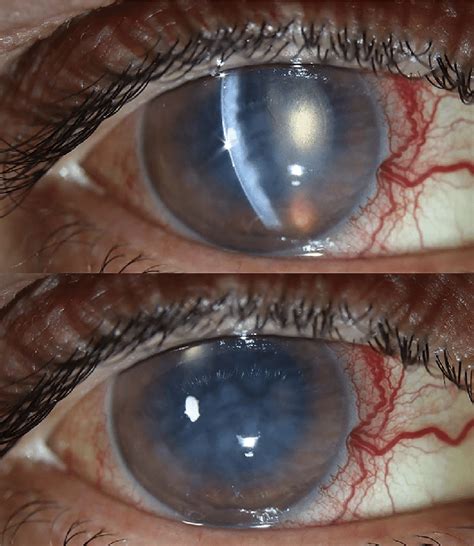 Causes Of Postoperative Corneal Edema