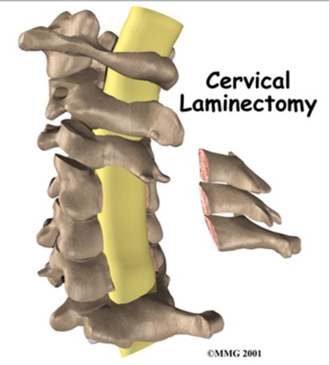 Canal Cervical étroit Chirurgie Orthopédique