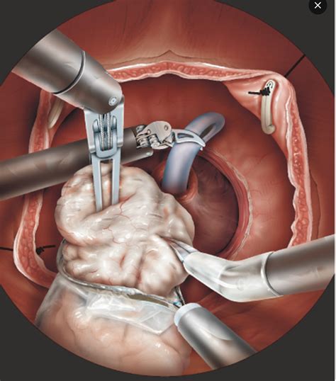 Robotic Assisted Simple Prostatectomy Rasp Explore Bph Solutions